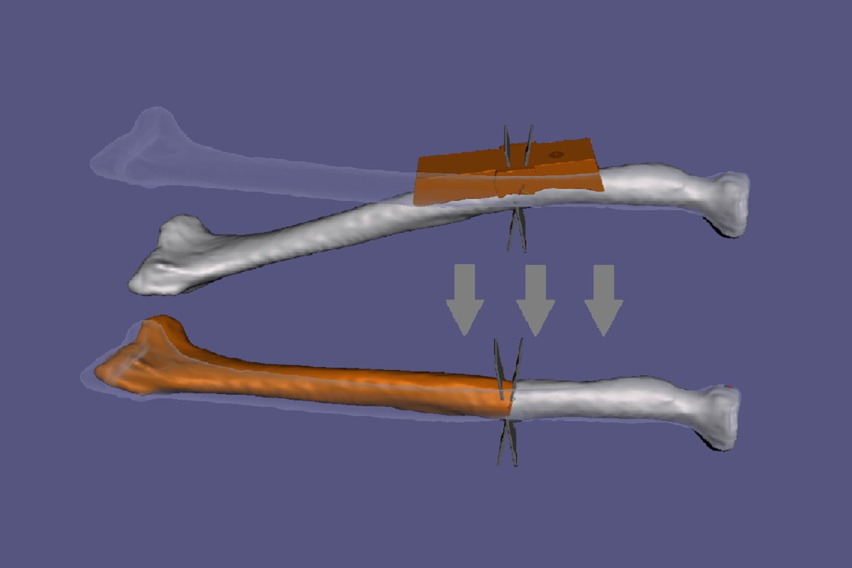 Yanlış Kaynama | Kırık Tedavisi (Diz, Dirsek)